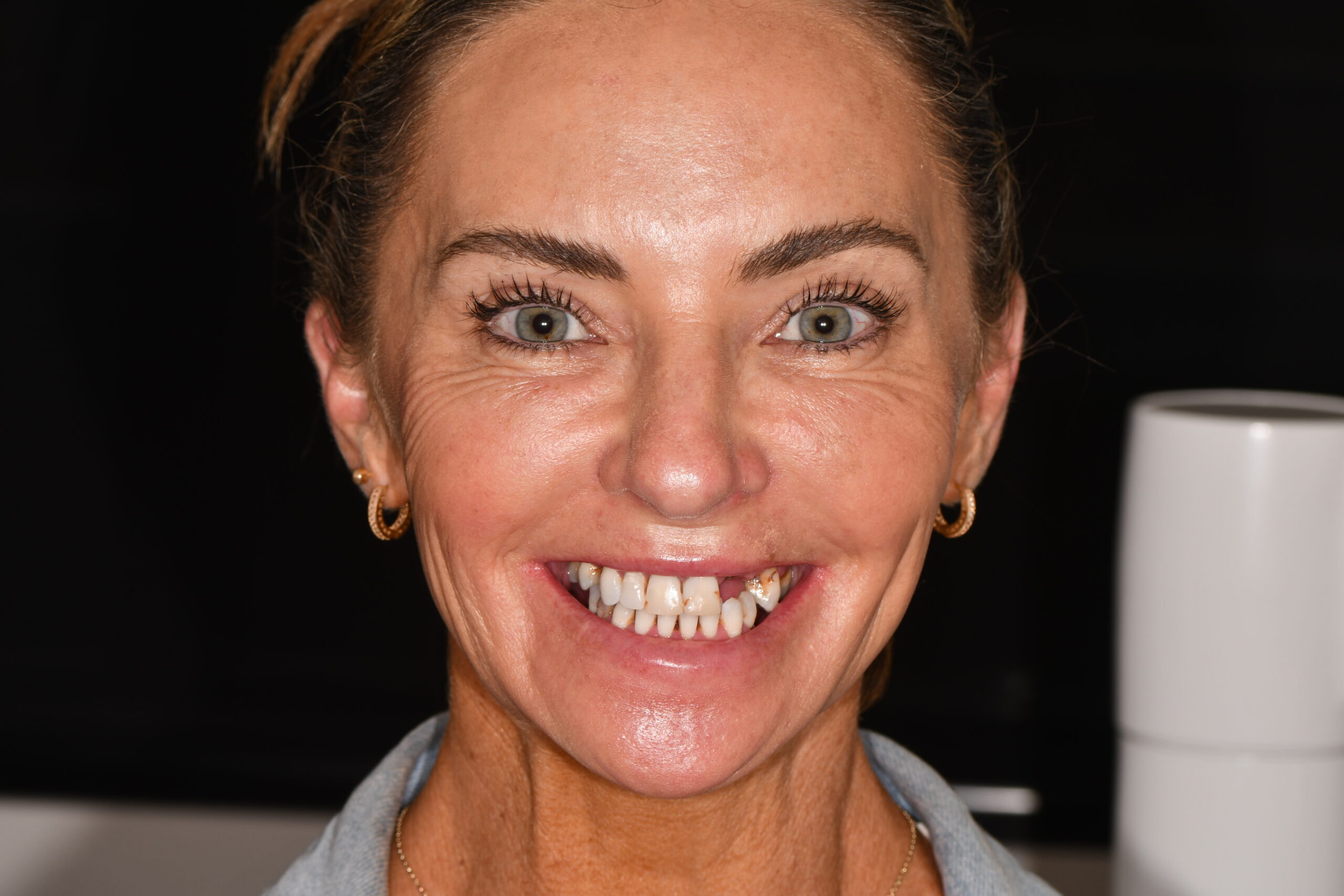 Full Mouth Rehabilitation with Implants and Restorations | Contemporary ...