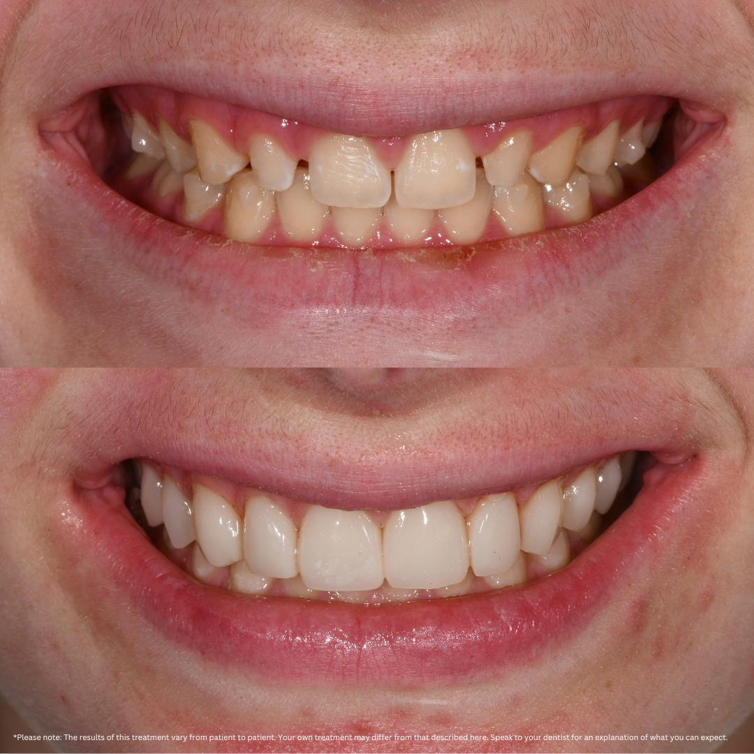 Full Mouth Reconstruction with Upper and Lower Fixed Bridges Supported ...