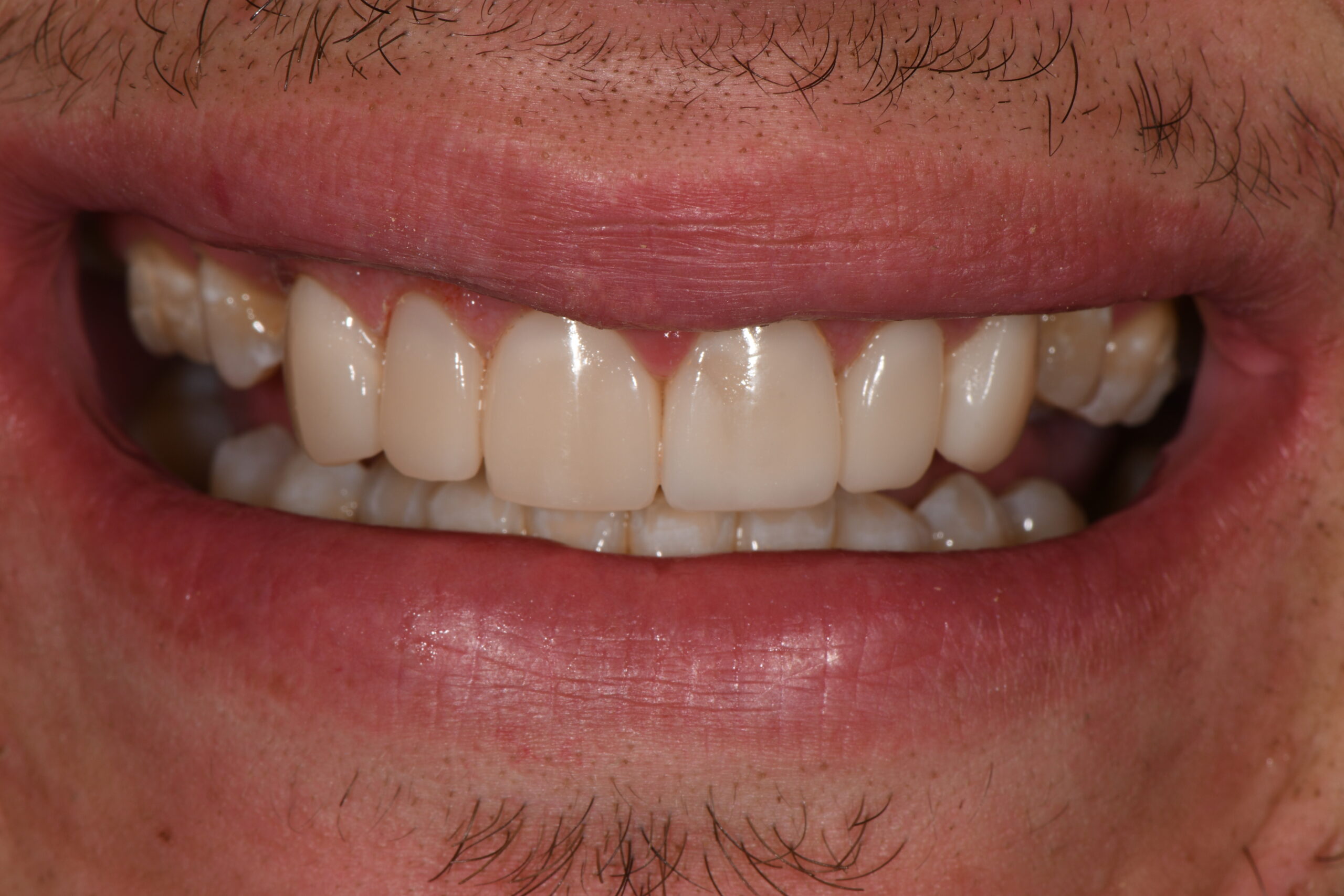 Restoration of Upper Arch using Resin Veneers | Contemporary Smiles Dental