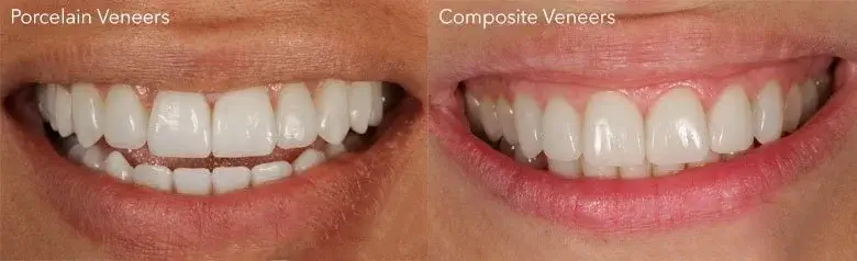 Dental Veneers: A Comprehensive Guide to Transform Your Smile ...