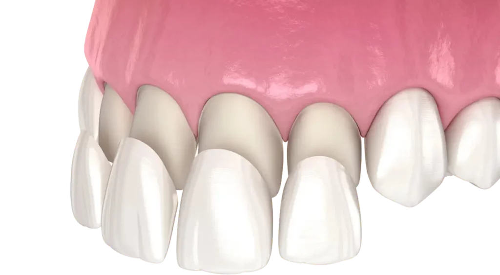 Dental Veneers: A Comprehensive Guide to Transform Your Smile ...
